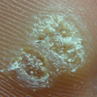 Plantar vorter - Sider [1] - Verden leksikon kunnskap