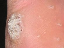 Plantar vorter - Sider [1] - Verden leksikon kunnskap